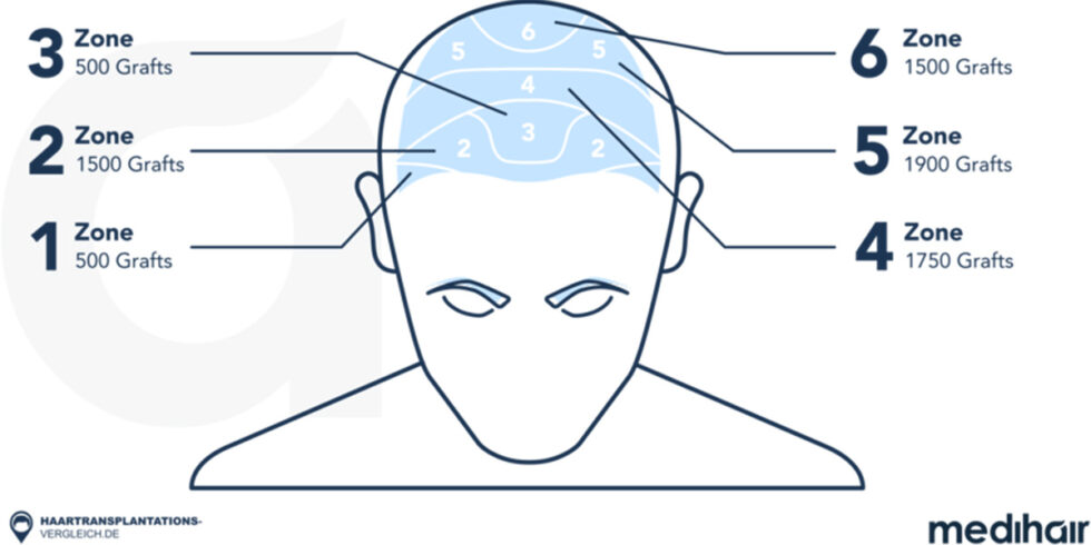Stufen des Haarausfalls // DHI Vienna