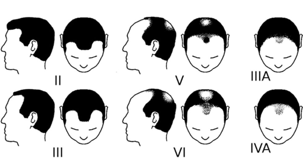 Stufen des Haarausfalls // DHI Vienna