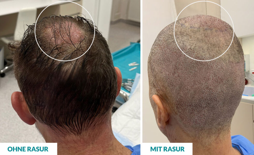 Haartransplantation ohne Rasur / DHI Vienna